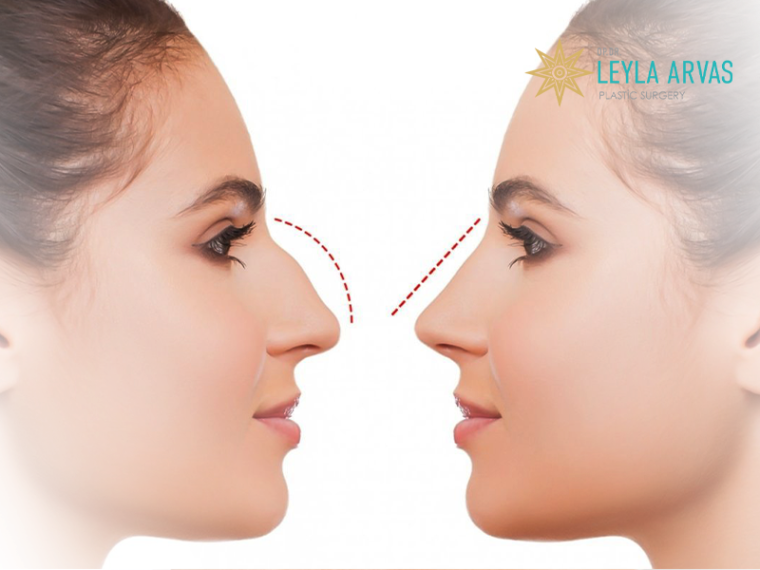 Burun Dolgusu Nedir? Nasıl Yapılır? - Op. Dr. Leyla