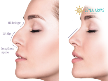 Nose Tip Lift - Recovery Process, Benefits, and Costs 2025