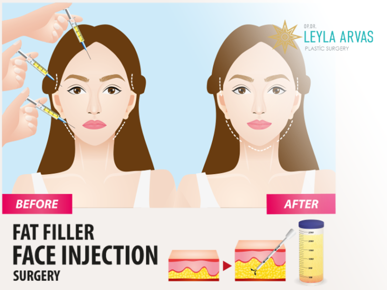 Fat Transfer To Face - Recovery, Risks & Costs 2025