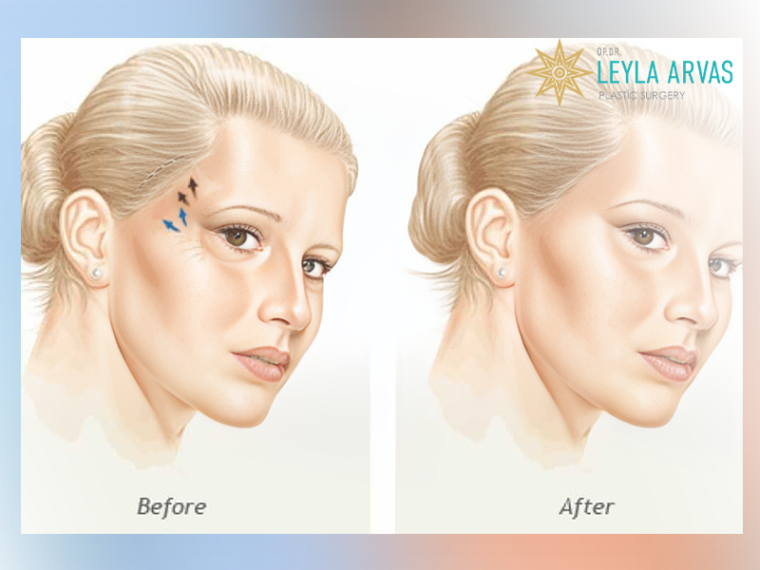 Temple Filler - A Non-Surgical Rejuvenation Solution - 2025